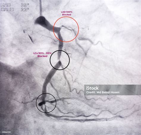 Coronary Angiogram Of Left Coronary Artery During Cardiac