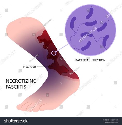 Bacteria Infection On Skin Cancer Necrotizing Stock Vector Royalty