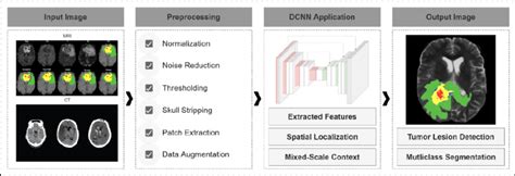 Shows suggested roadmap and stages of a typical brain tumor... | Download Scientific Diagram