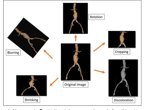 Figure 1 From Applying Artificial Intelligence To Predict Complications After Endovascular