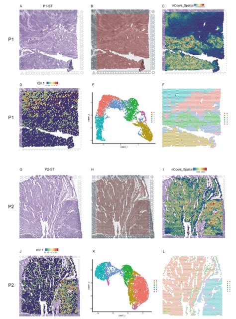 成功案例 空间转录组联合单细胞核转录组测序揭示子宫平滑肌瘤潜在治疗策略 分析 研究 图谱
