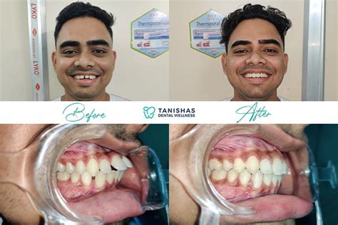 Different Types Of Dental Braces Tanishas Dental Wellness