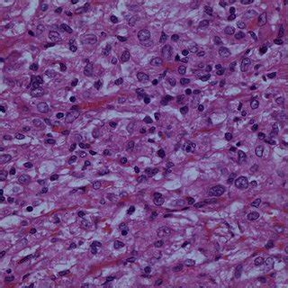 Histopathology Showed Sheets Of Epithelioid And Spindle Shaped Cells Of Download Scientific