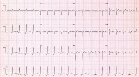 Junctional Tachycardia Ecg