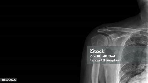 필름 엑스레이 어깨 방사선 사진은 혈관 및 견봉 쇄골 관절의 퇴행성 골관절염 질환을 보여줍니다 환자는 통증과 뻣뻣함 문제가 있습니다 의료 개념 해부학에 대한 스톡 사진 및