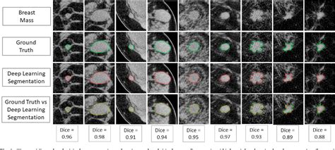 Figure 4 From Deep Learning Based Segmentation Of Breast Masses In