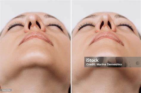 코 성형술 전후의 여성의 코 클로즈업 비강 중격 교정 개선에 대한 스톡 사진 및 기타 이미지 개선 건강관리와 의술 굽은 Istock