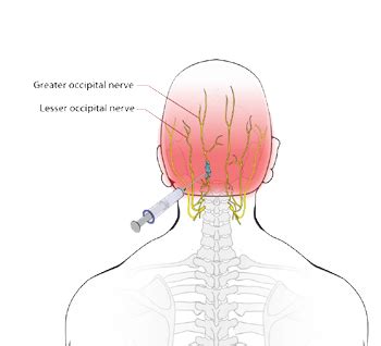 Greater Occipital Nerve Block