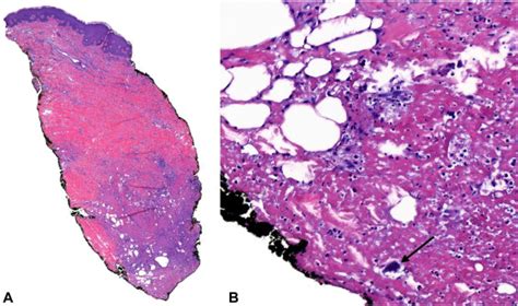 Distinguishing Dystrophic Calcification From Calciphylaxis Jaad Case Reports