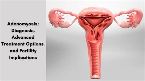 Adenomyosis Diagnosis Advanced Treatment Options And Fertility