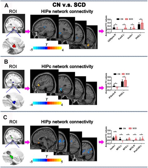 Rtms Modulates Precuneus Hippocampal Subregion Circuit In Patients With