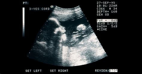 Committee Advances Bill Adding Pregnancy Ultrasound Video To Indiana