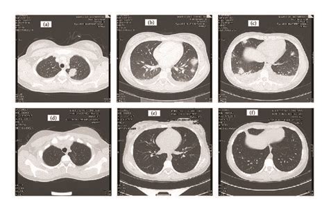 A B C Ct Scan Of The Thorax Demonstrating Bilateral Nodular Lesions Download Scientific