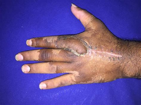 First Dorsal Metacarpal Artery Flap Quaba Flap Dr Sathya Vamsi Krishna