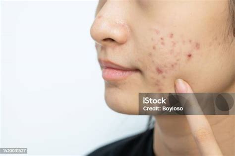 그녀의 뺨에 여드름 문제를 가리키는 여성의 잘린 샷 블랙헤드에 대한 스톡 사진 및 기타 이미지 블랙헤드 사람 얼굴 여드름 Istock