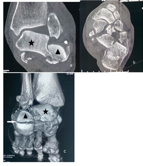 Figure 2 From Unusual Case Of Lateral Subtalar Joint Dislocation Associated With Calcaneal