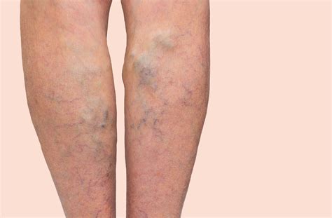 Varicose Veins Causes Symptoms And Ayurvedic Treatment Vedic Upchar