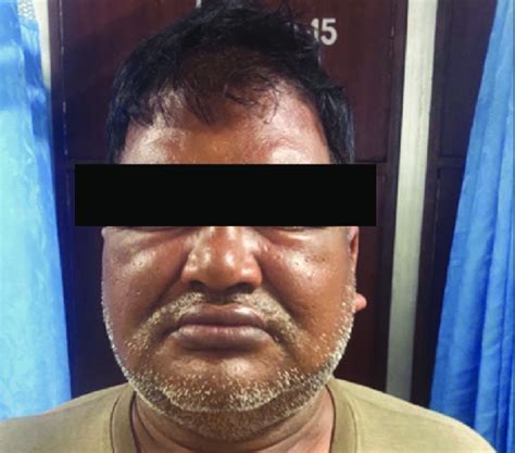 Facial Swelling After A Bee Sting Download Scientific Diagram