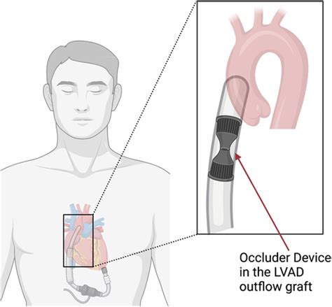 Lvad