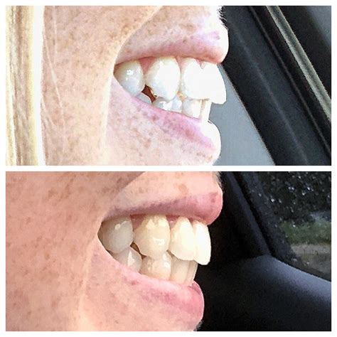 Invisalign Ipr Before And After At Todd Briggs Blog