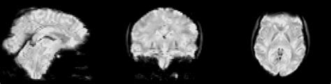 Problems With Csf During Fmri Distortion Correction Portion Of Fmriprep Data From Phillips