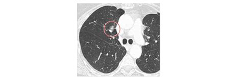 Artificial Intelligence Lung Cancer Screening Platform For Solitary Pulmonary Nodules Khalpey