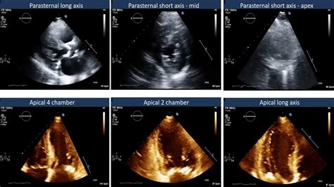 Tte Acute Mid Lad Infarct Youtube