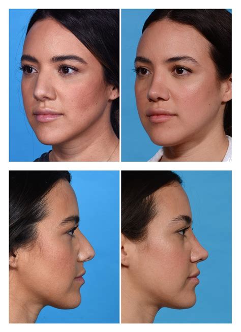 Tip Rhinoplasty Before And After Photos