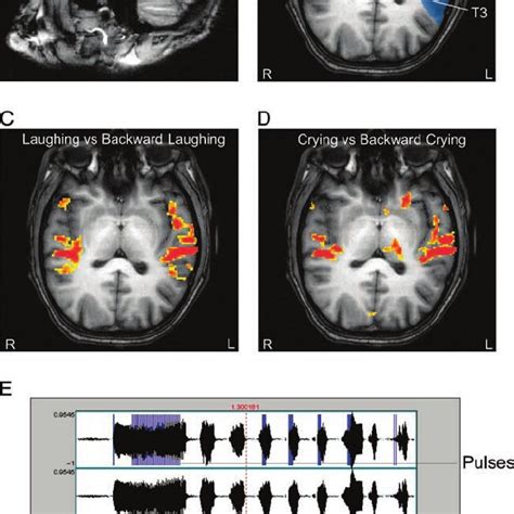 Pdf Left Auditory Cortex And Amygdala But Right Insula Dominance For