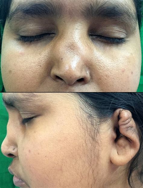 Saddle Nose And Bilateral Cauliflower Ear Deformities With Pyoderma Gangrenosum Like Ulcers