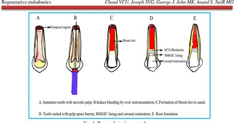Regenerative Endodontics In Mature Teeth At Bobby Mosca Blog
