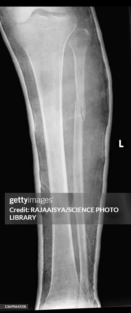X Ray Leg Fracture Pinned Leg Fracture X Ray Stock Image
