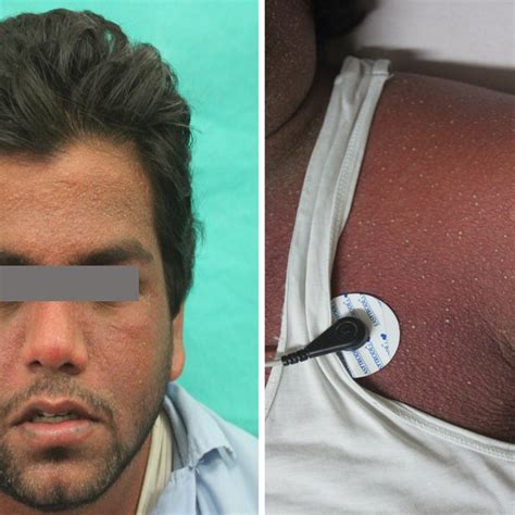 Maculopapular Rashes On Chest And Abdomen Download Scientific Diagram