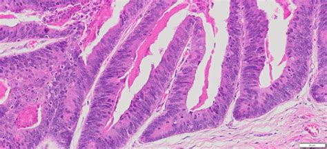 Human Gastric Stomach Adenocarcinoma Ffpe Sections