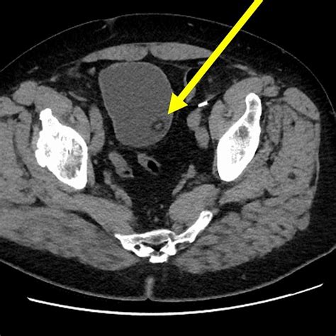 Ct Urogram Showing Calcification Of Neobladder From Staple Line Erosion