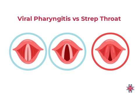 Pharyngitis A Comprehensive Guide To Symptoms Causes Prevention And
