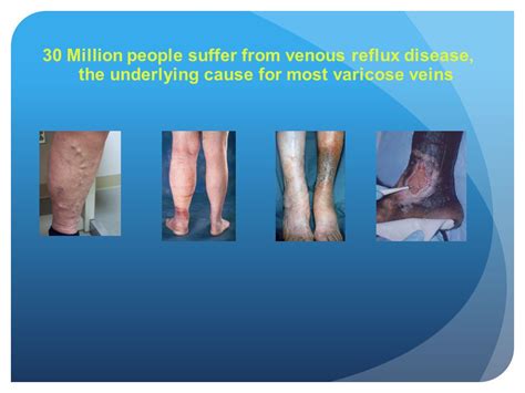 Lower Extremity Venous Reflux