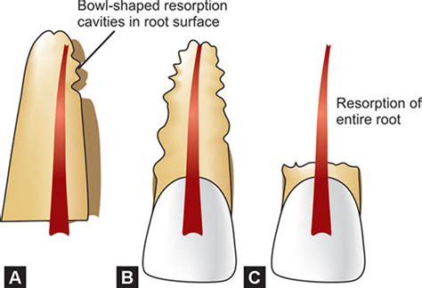 External Resorption Vs Internal Resorption