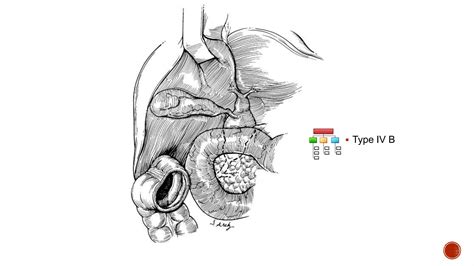 Choledochal Cysts Introduction Classification Pathogenesis And Management Pptx