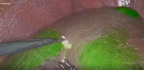 Minimally Invasive Anatomic Resection Of Liver Segment Viii Based On Portal Territory To Treat