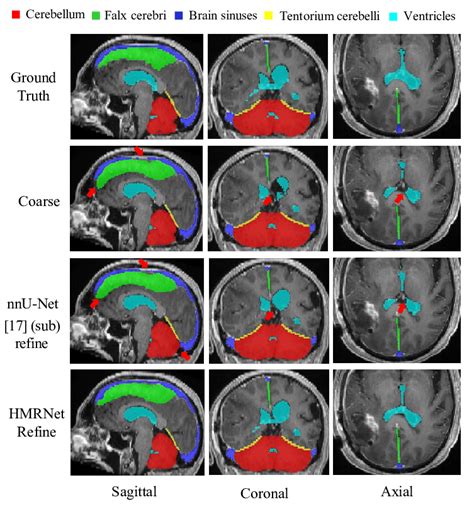 Visual Comparison Of Coarse Segmentation And Refinement Based On