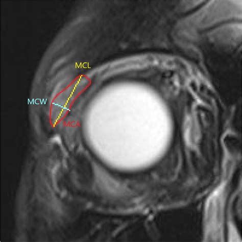 Definition Of MCA MCL And MCW MCA Maximum Coronal Area Download Scientific Diagram