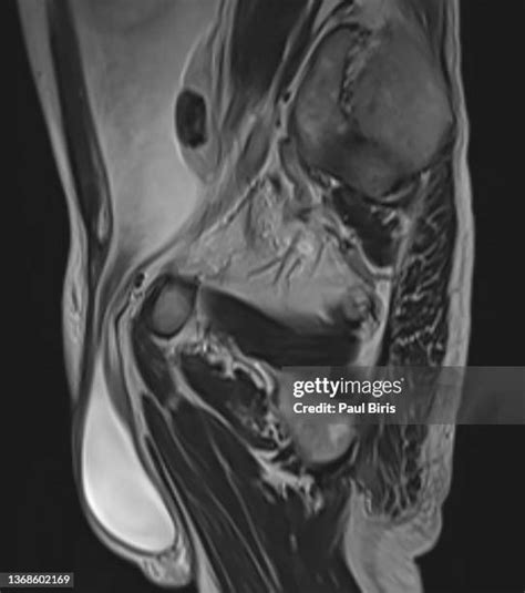 Inguinal Hernia Photos And Premium High Res Pictures Getty Images