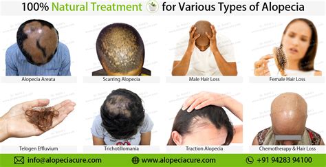 Types Of Alopecia Hair Loss