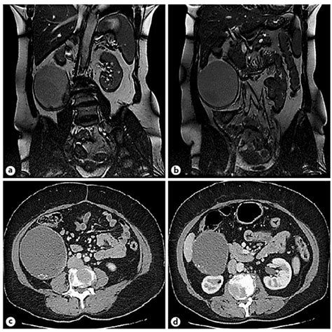 Ct Of The Abdomen Of Patient 2 Showing The Inflamed Appendix Green