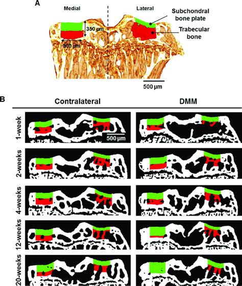 Automated Compartmentalisation Of Epiphyseal Subchondral Bone Over Oa