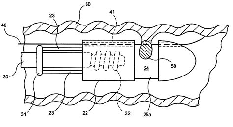 Endoscopic Resection Patented Technology Retrieval Search Results Eureka Patsnap