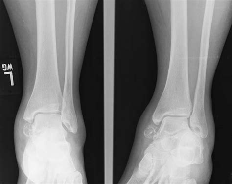 Notable Well Circumscribed Calcific Density On Radiograph Download Scientific Diagram
