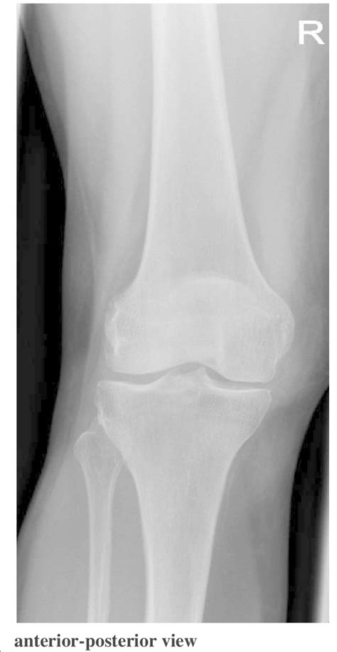 X Ray Picture 4 Months After Surgery Calcification Deposit Completely