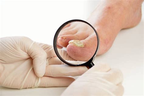 동탄 발톱무좀 증상부터 오니코 레이저 치료까지 알려드립니다 네이버 블로그